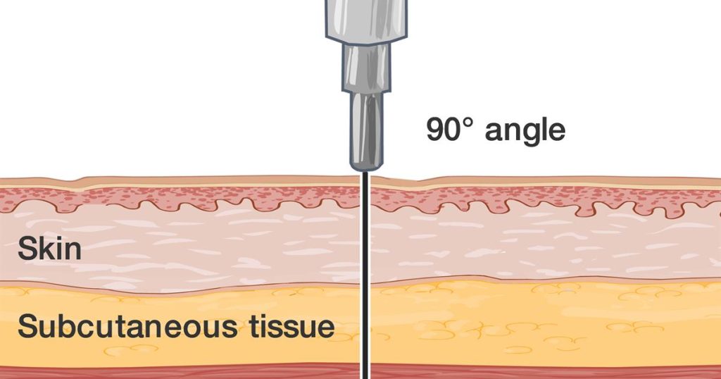 Ενδομυϊκή Ένεση | ΕΠΕΙΓΟΝΤΑ